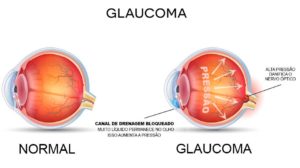 O que é Glaucoma?