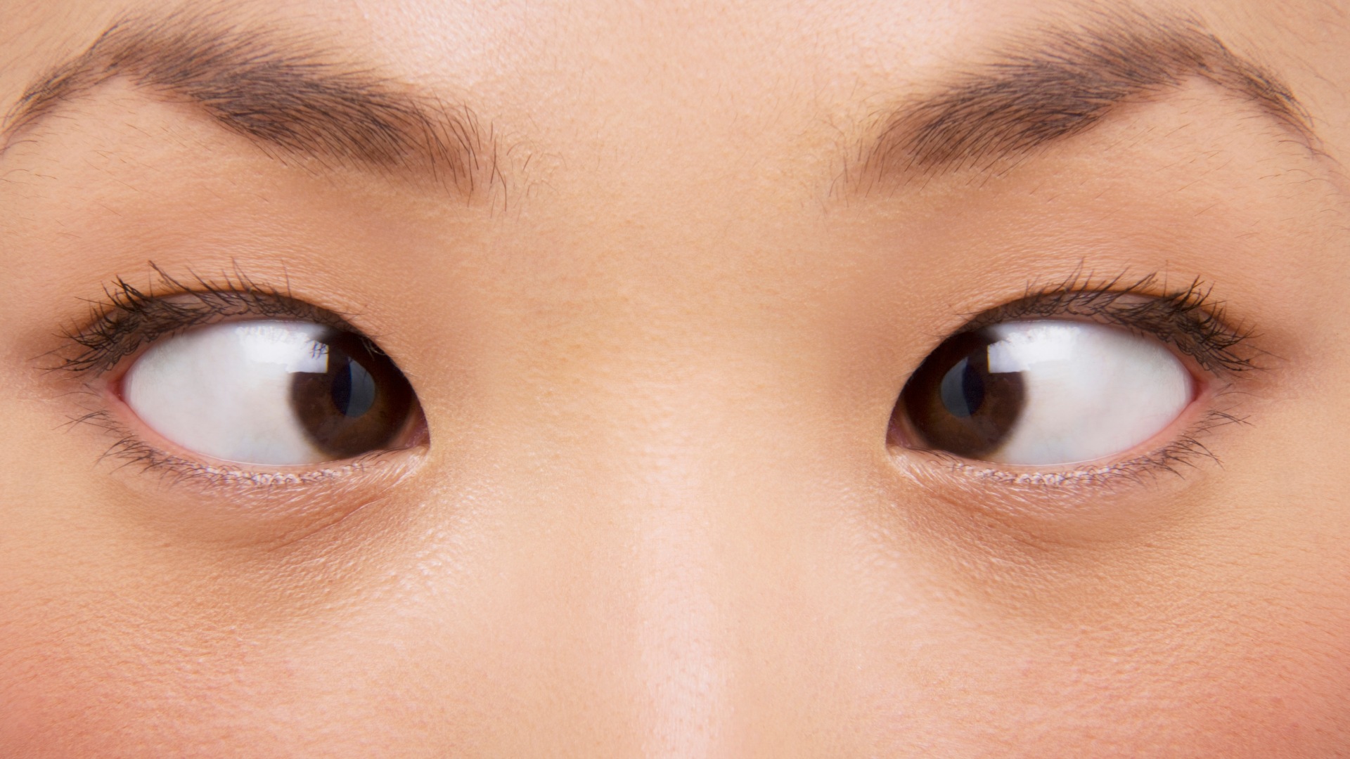 Você sabe o que é estrabismo? A gente te explica